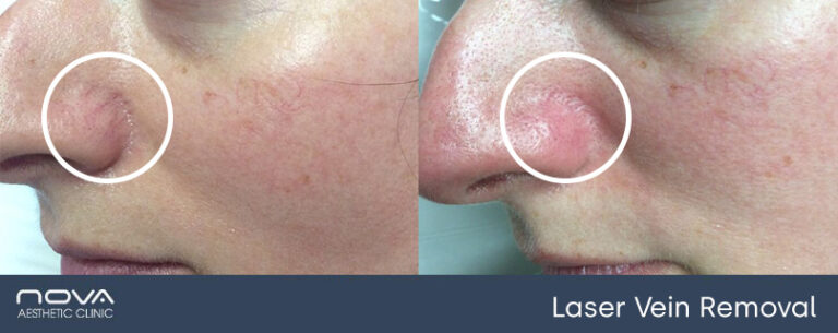 Laser Vein Treatments - Nova Aesthetic Clinic