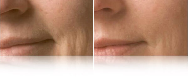 Oxygen Facial - Nova Aesthetic Clinic
